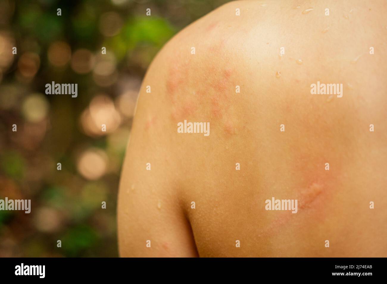 Woman with itching from biting insect in body in tropical jungle forest ...