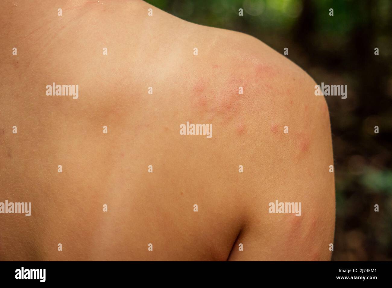Woman with itching from biting insect in body in tropical jungle forest ...