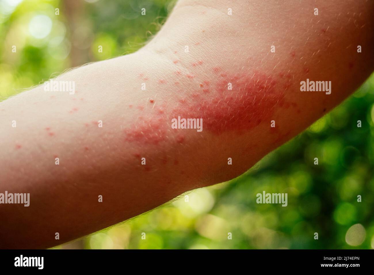 Woman with itching from biting insect in body in tropical jungle forest ...