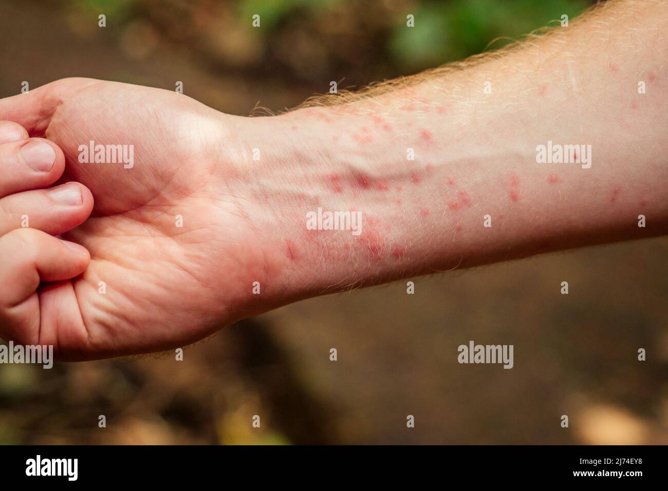 Woman with itching from biting insect in body in tropical jungle forest ...