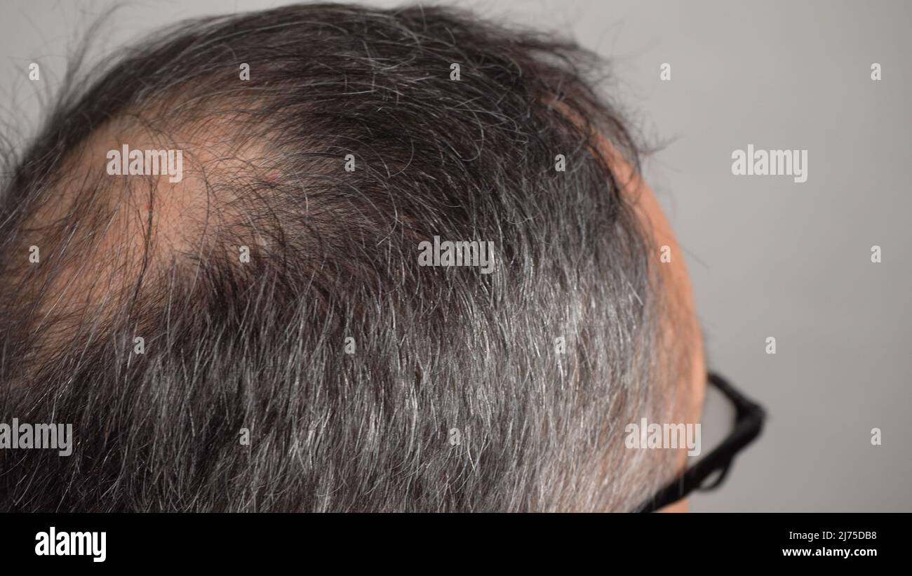 Gray hair on a man's head Stock Photo - Alamy