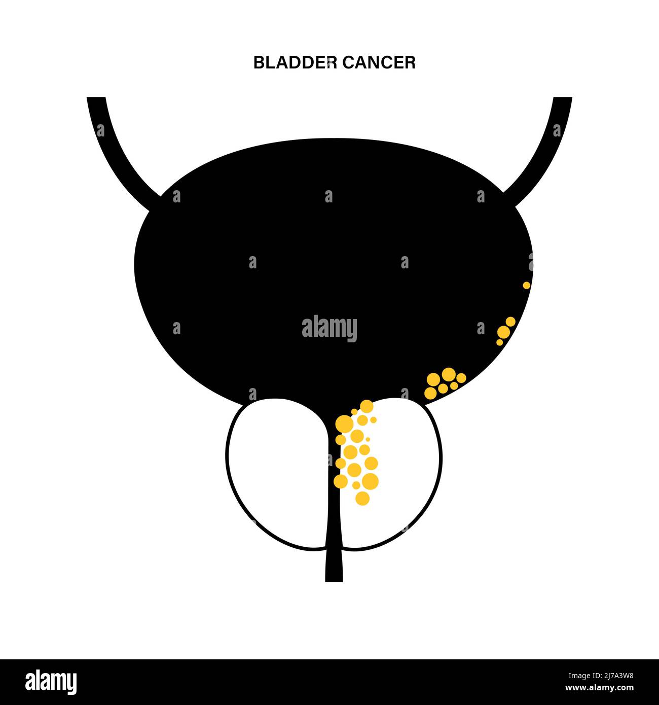 Bladder cancer stages, illustration Stock Photo - Alamy