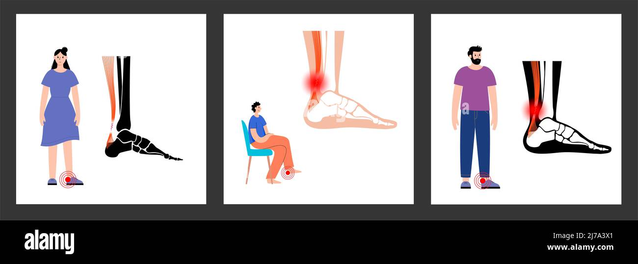 Tendinitis illustration hi-res stock photography and images - Alamy