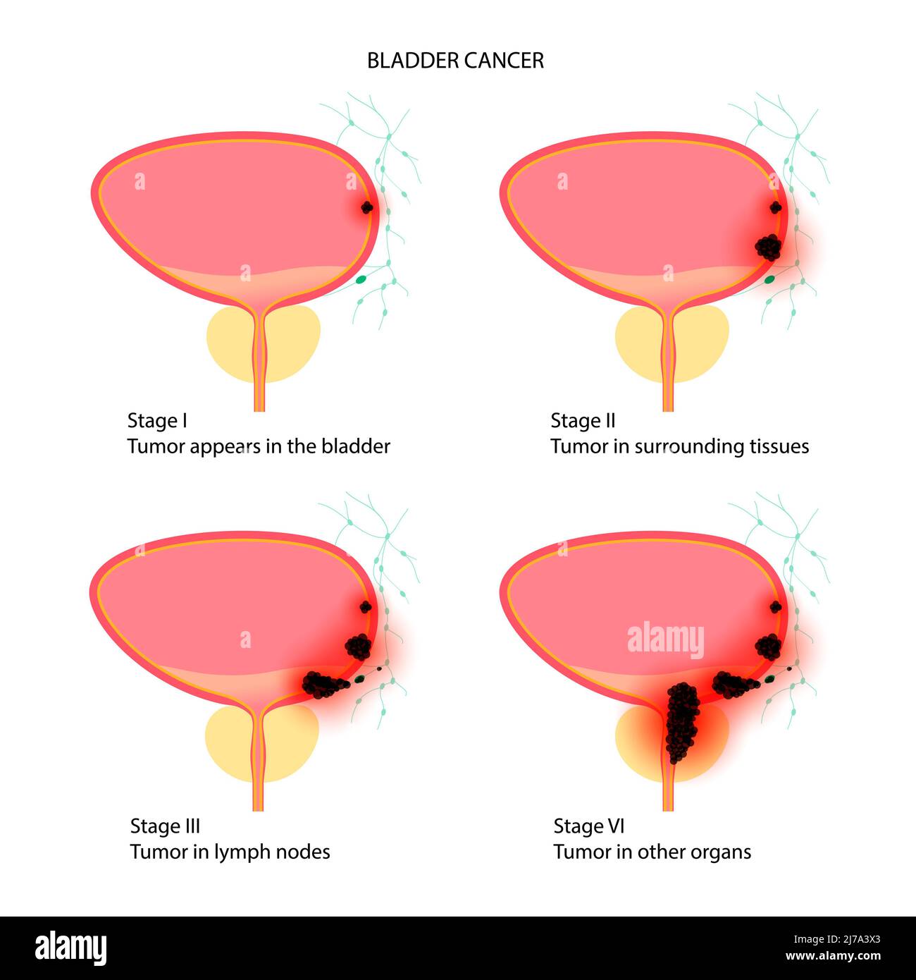 Bladder cancer stages, illustration Stock Photo - Alamy