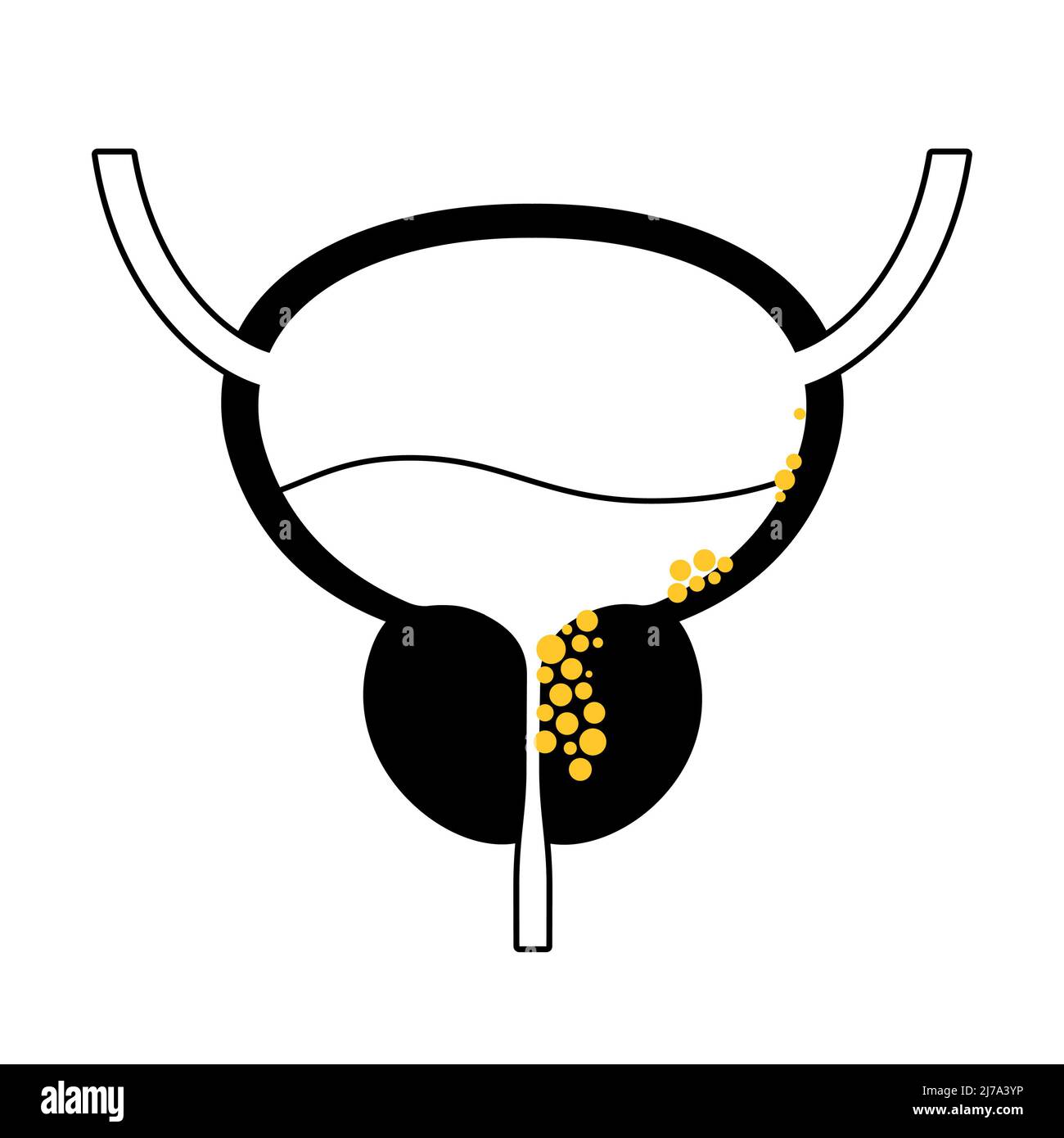 Bladder cancer stages, illustration Stock Photo - Alamy