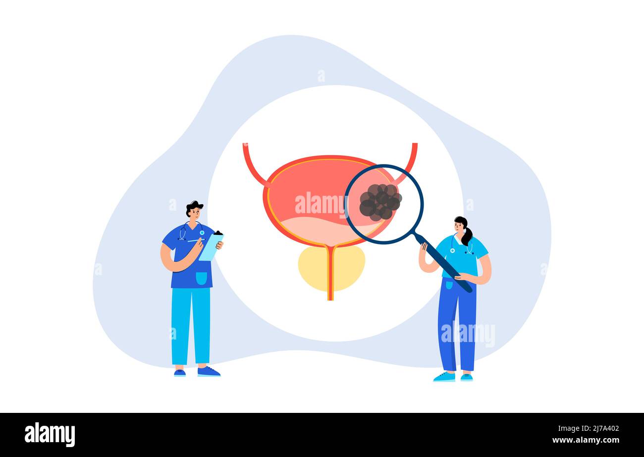 Bladder cancer stages, illustration Stock Photo - Alamy