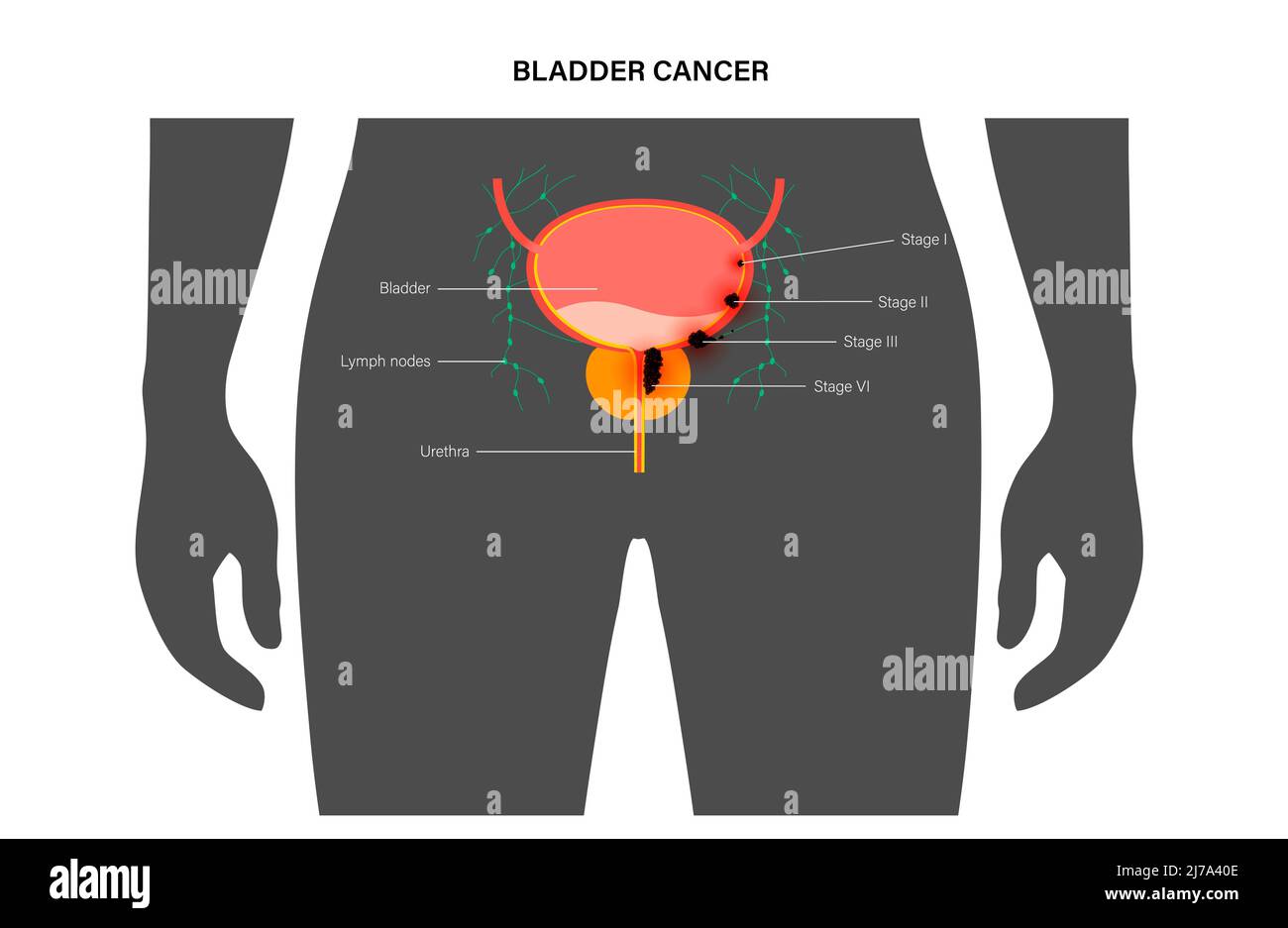 Bladder cancer stages, illustration Stock Photo - Alamy