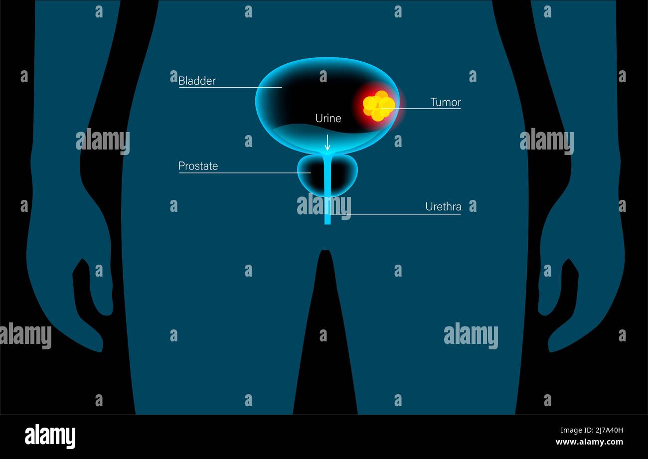 Bladder cancer x ray hi-res stock photography and images - Alamy