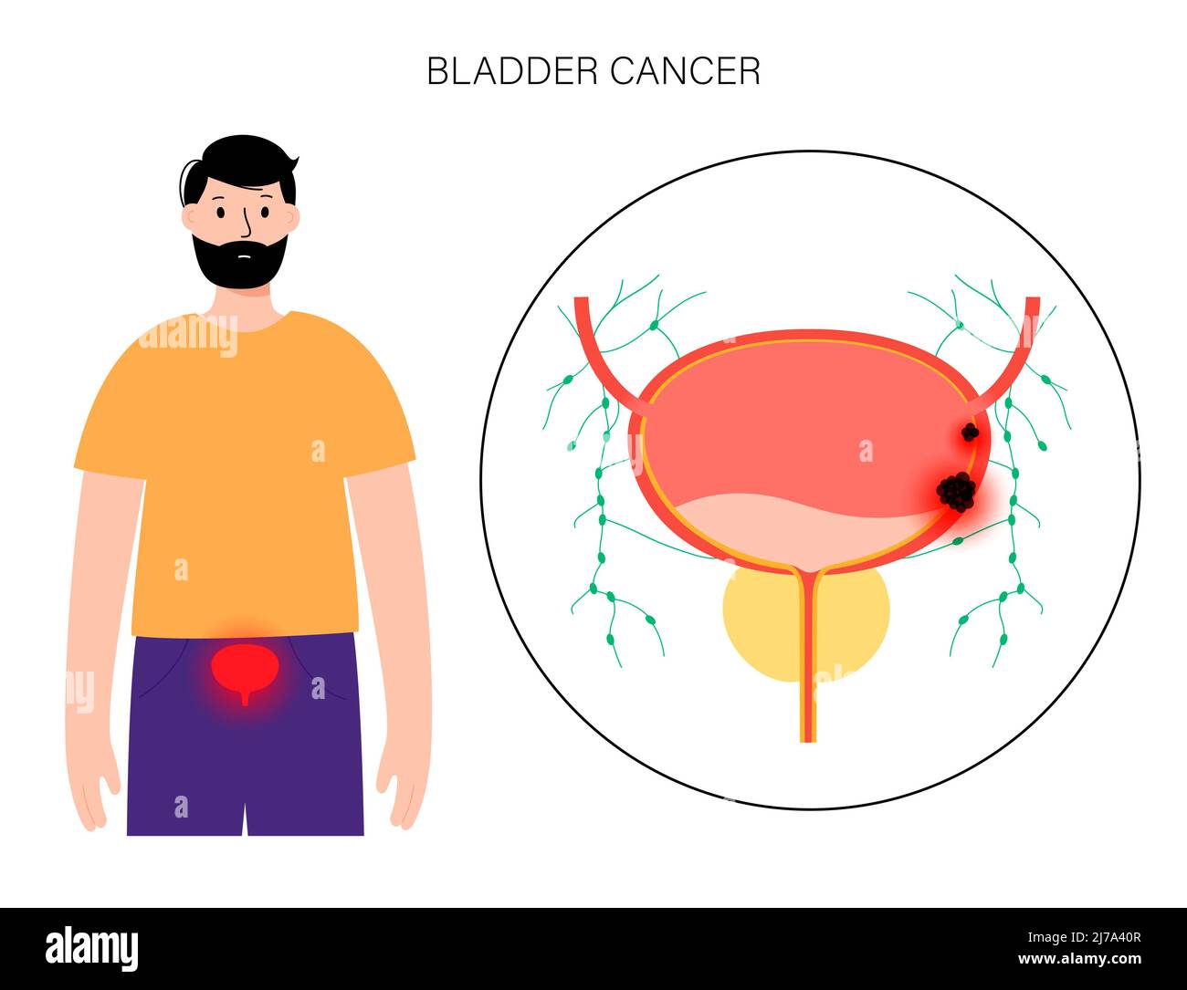 Bladder cancer stages, illustration Stock Photo - Alamy