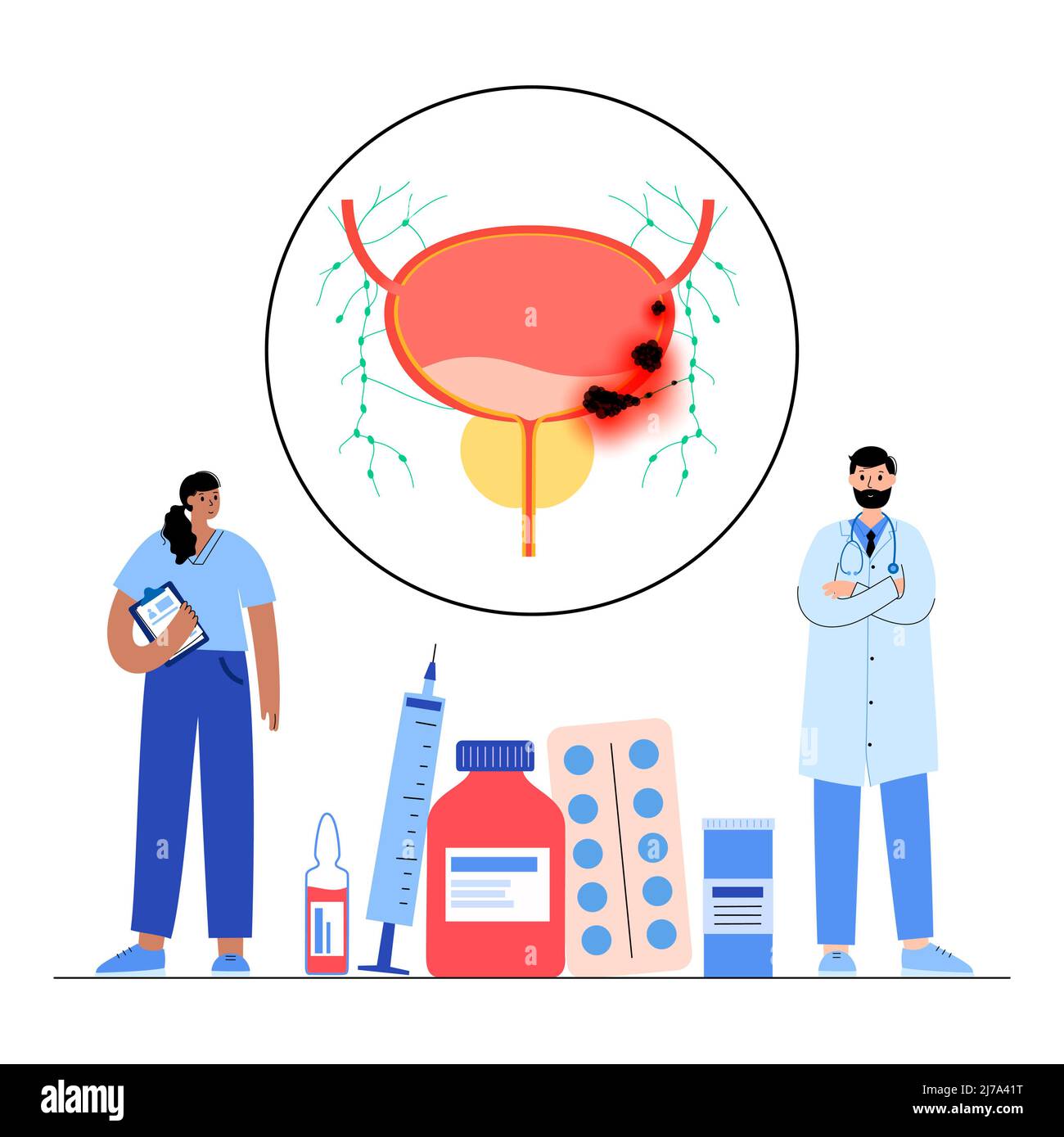 Bladder cancer stages, illustration Stock Photo - Alamy