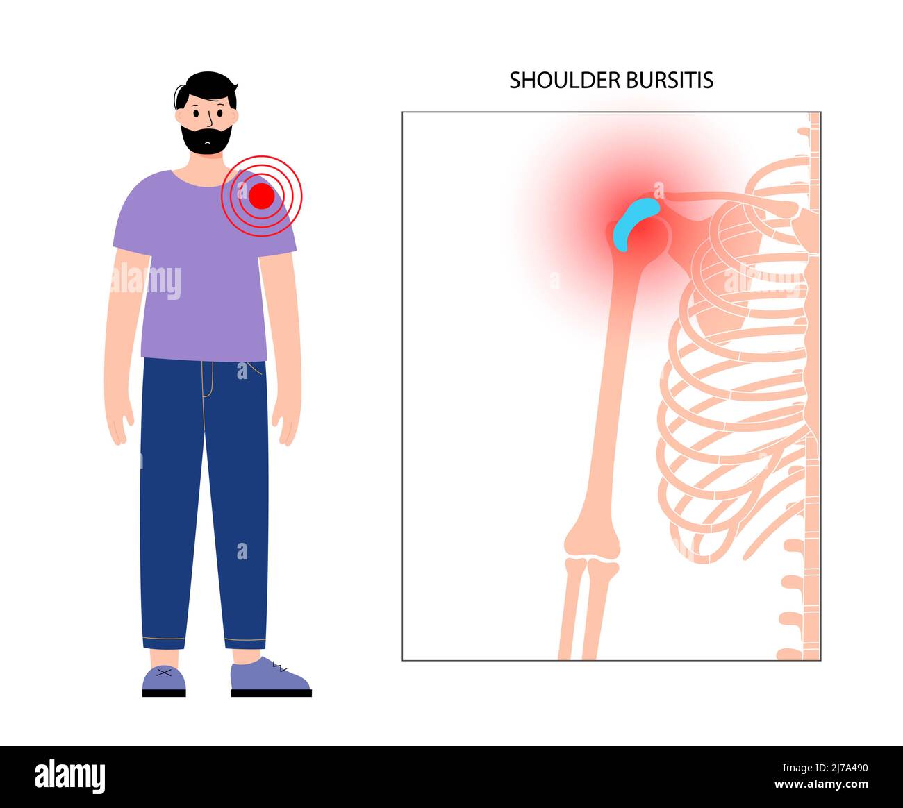 Shoulder bursitis, conceptual illustration Stock Photo - Alamy