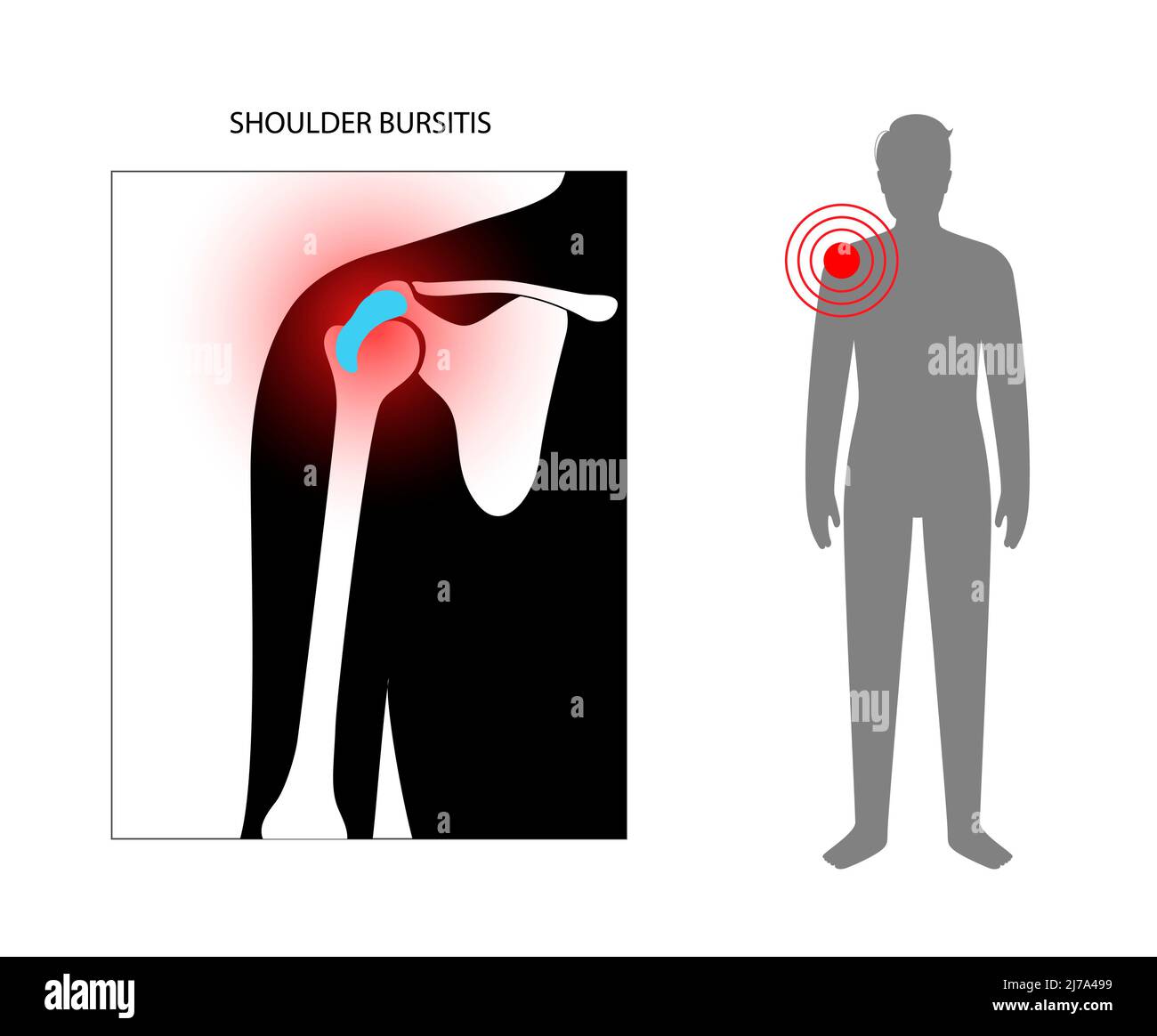 Subacromial bursitis hi-res stock photography and images - Alamy