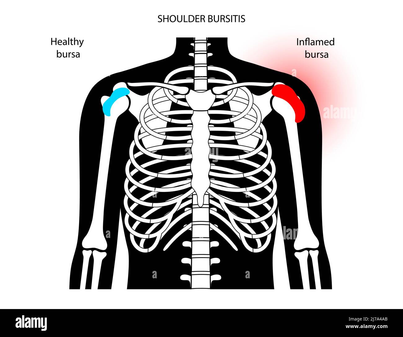 Subacromial bursitis hi-res stock photography and images - Alamy