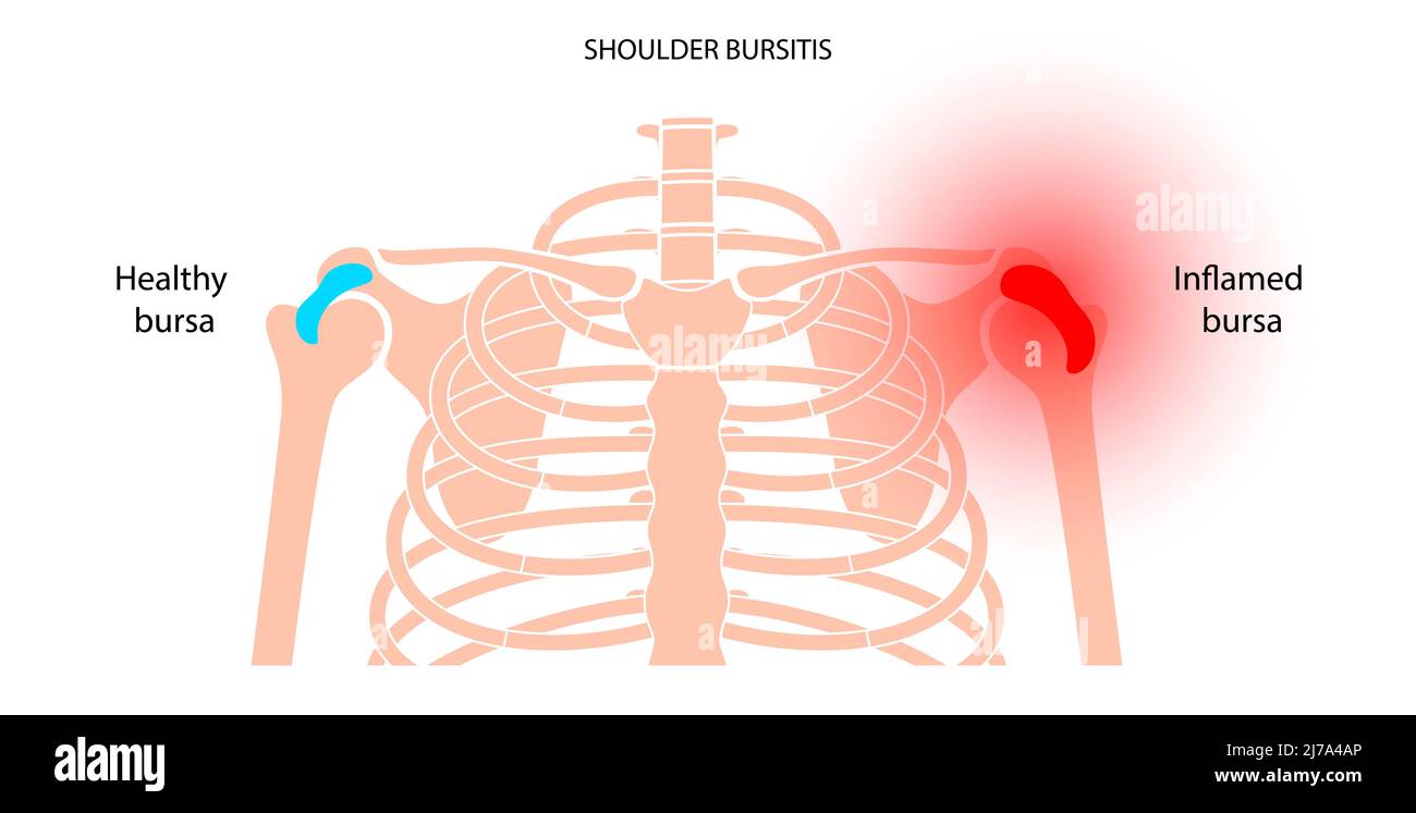 Subacromial bursitis hi-res stock photography and images - Alamy