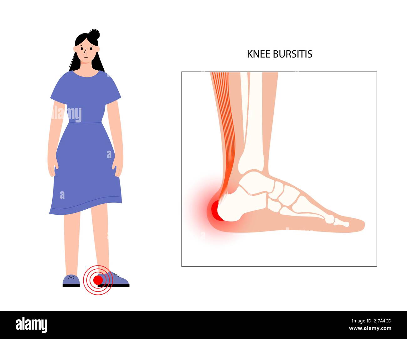 Achilles bursitis Cut Out Stock Images & Pictures - Alamy