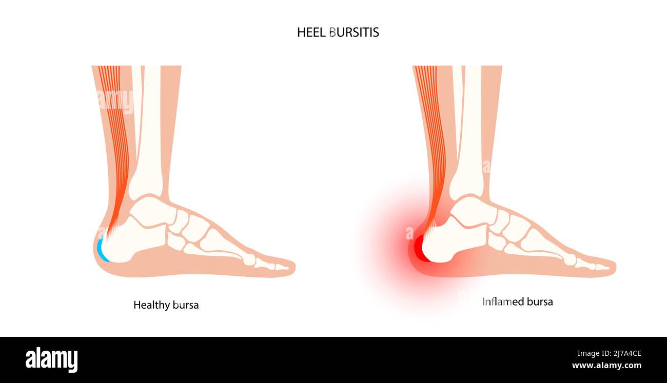 Heel Bursitis