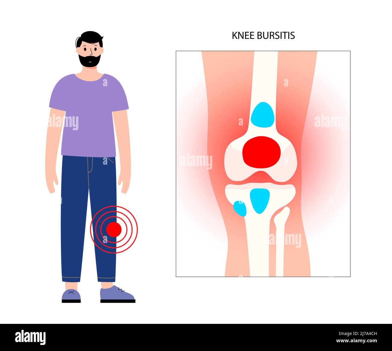 Knee bursitis, conceptual illustration Stock Photo - Alamy