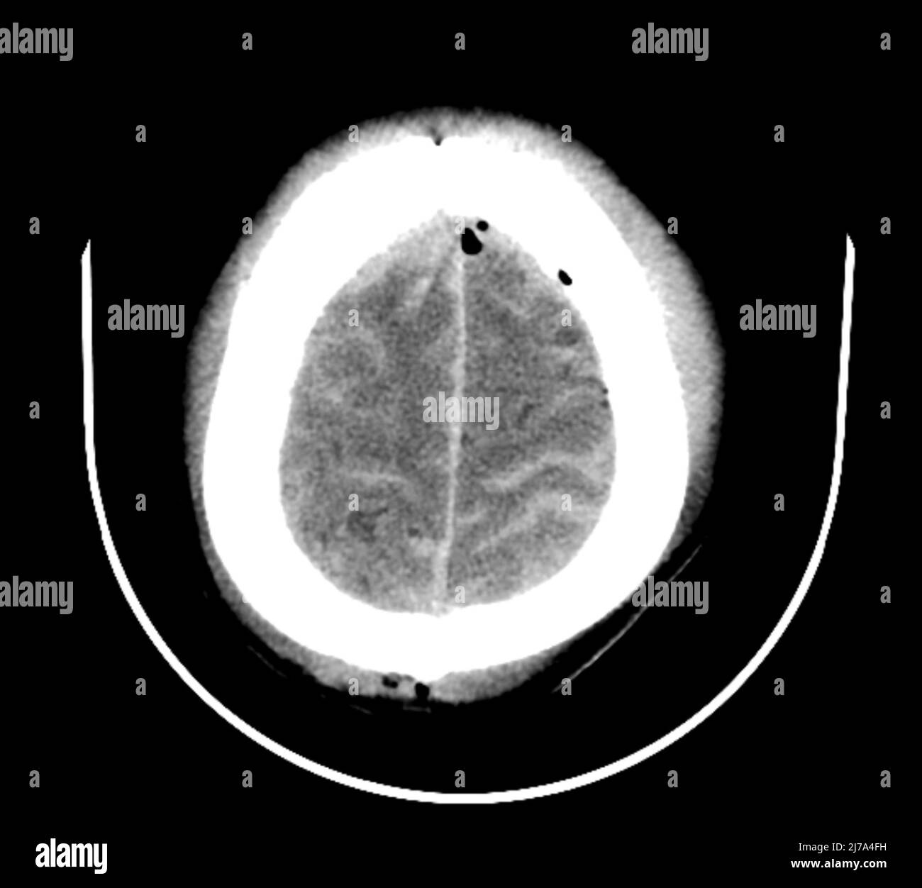 Traumatic brain injuries, CT scan Stock Photo - Alamy