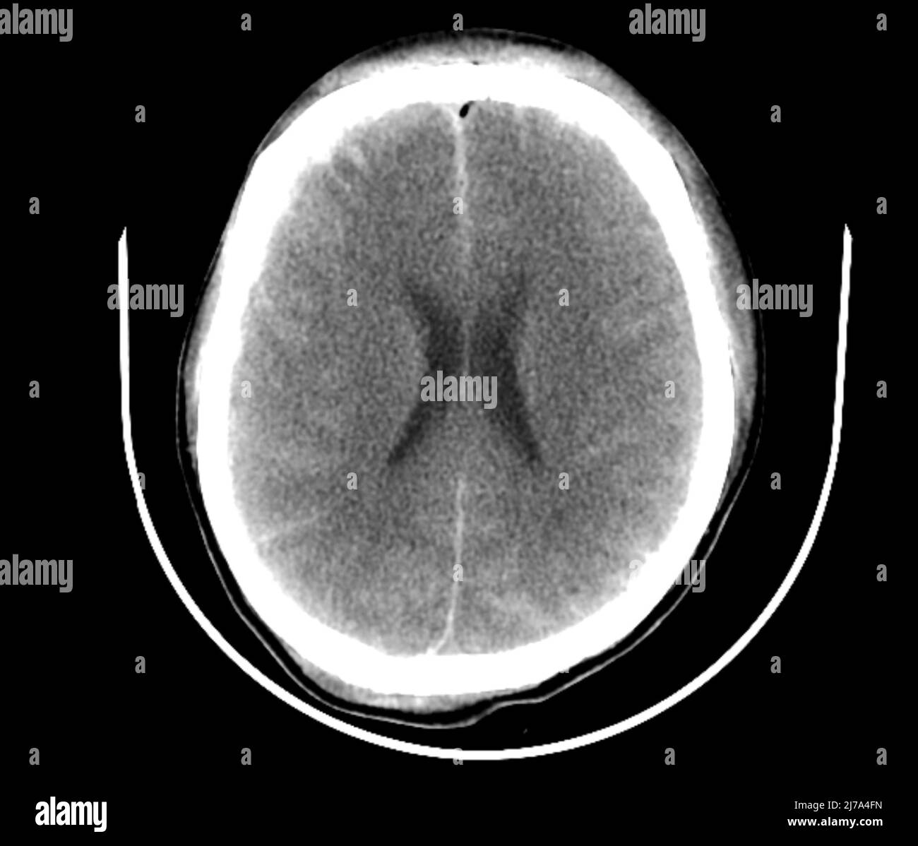 Traumatic brain injuries, CT scan Stock Photo - Alamy