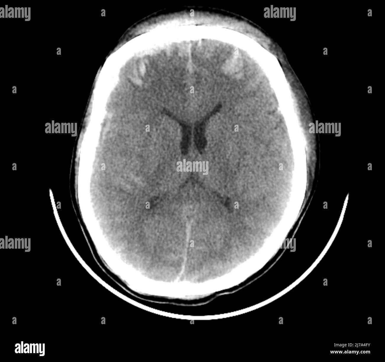 Traumatic brain injuries, CT scan Stock Photo - Alamy