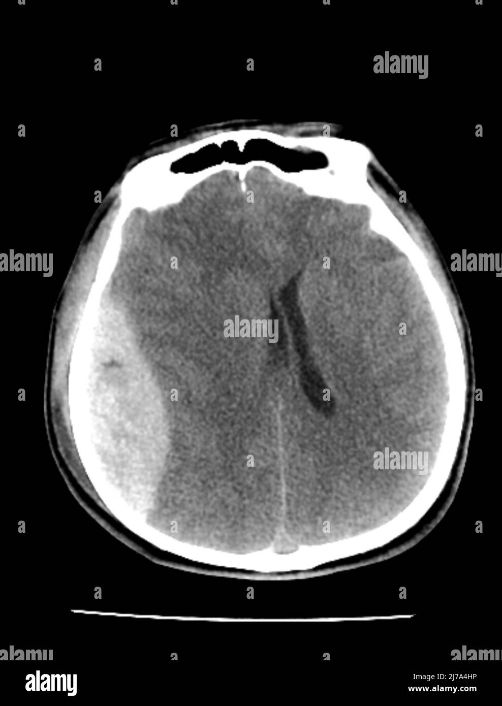 Traumatic brain injuries, CT scan Stock Photo - Alamy
