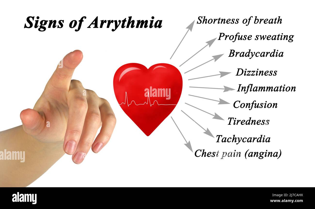 Presenting Nine Sign of Arrythmia Stock Photo - Alamy