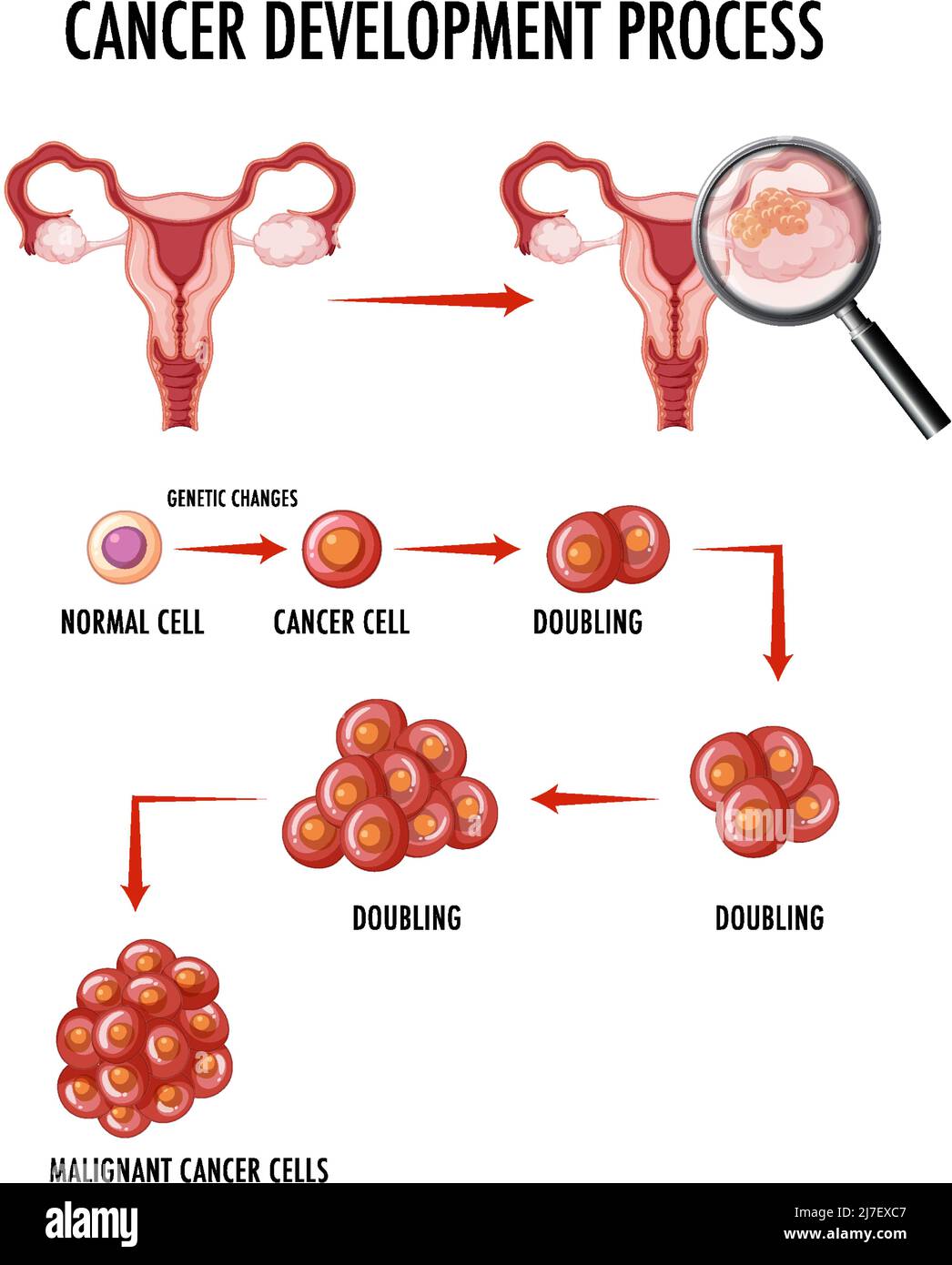 Diagram showing cancer in human ovary illustration Stock Vector Image ...