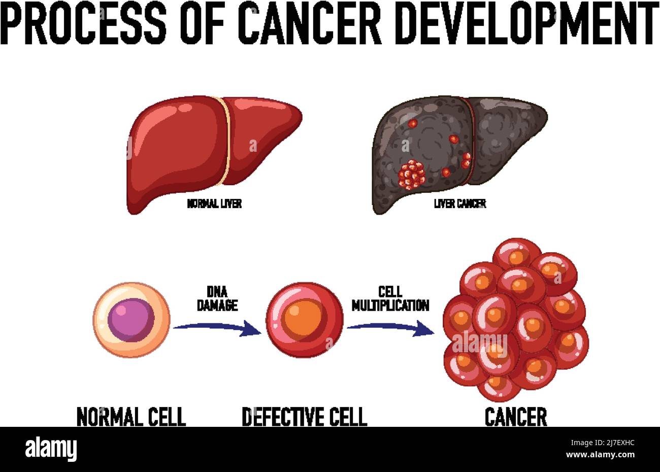 Diagram showing process of cancer development illustration Stock Vector ...