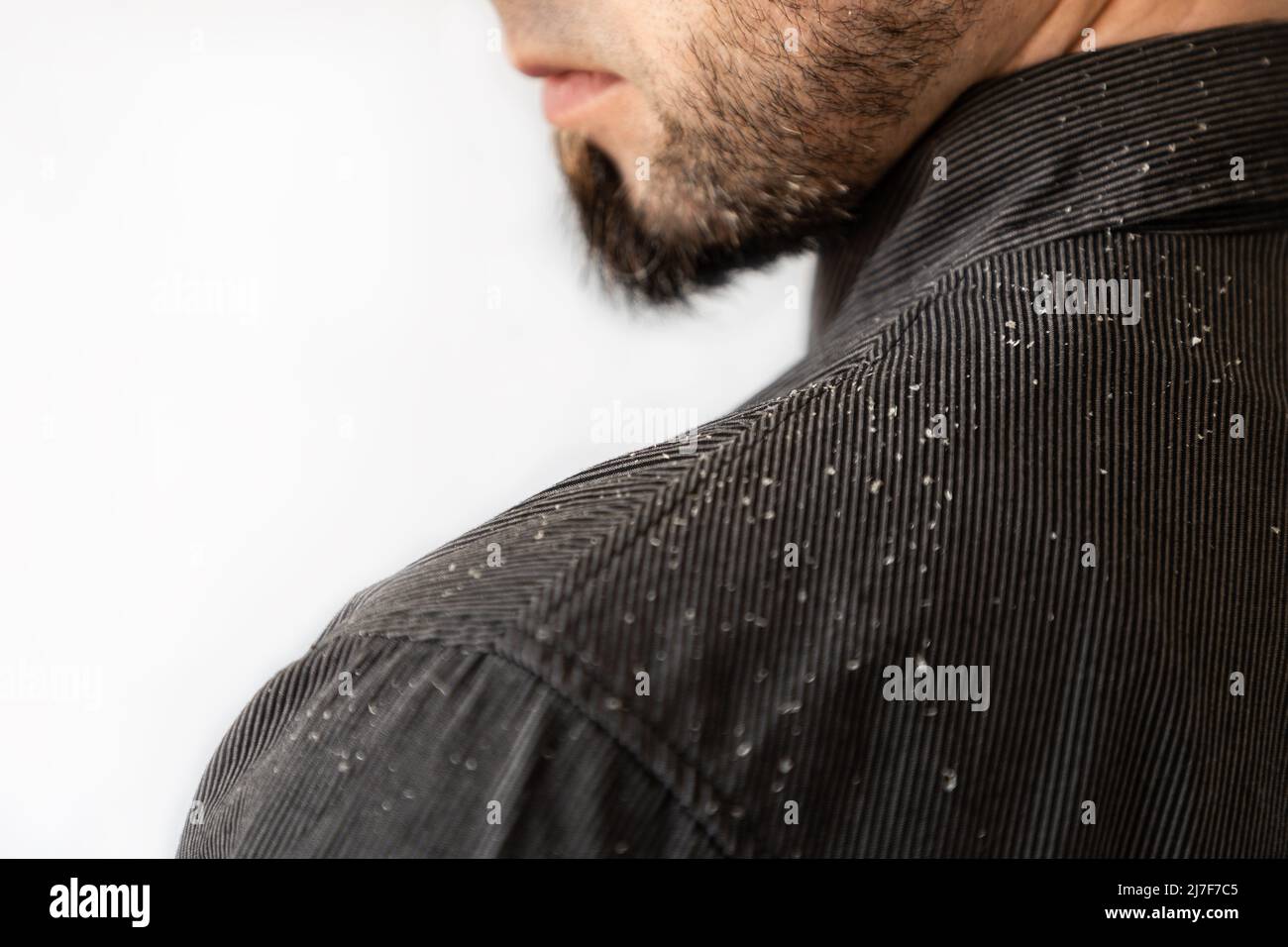 Close-up of a man's shoulder in a black shirt covered with dandruff ...