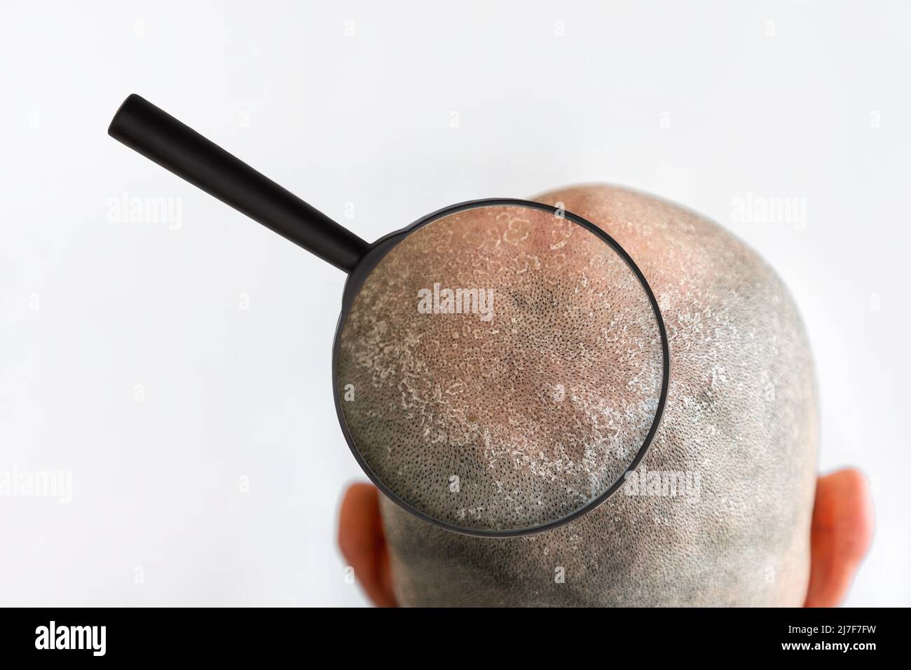 Man's bald flaky head with dandruff and zoomed with magnifier problem ...