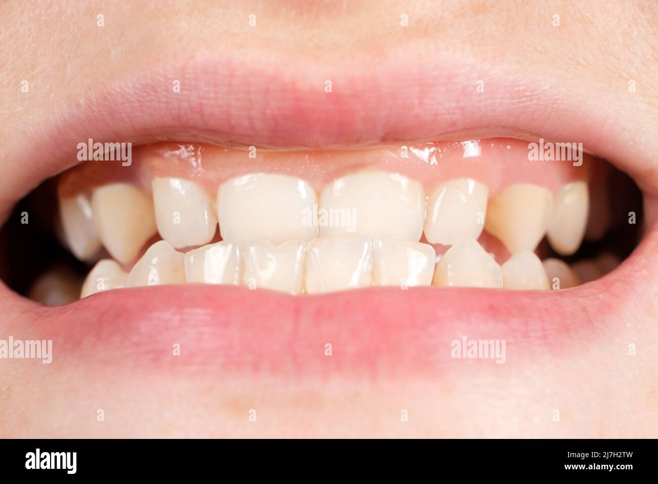 Patient with gingival smile, large gums and small teeth, microdentia ...