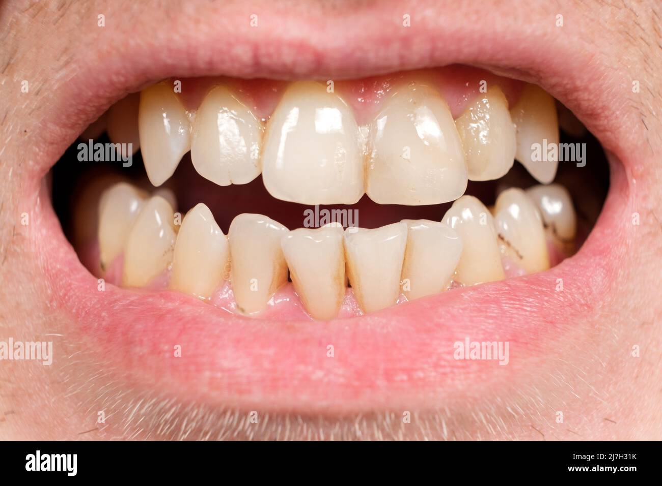 Teeth with tartar and caries, crooked lower foreground incisors, close ...