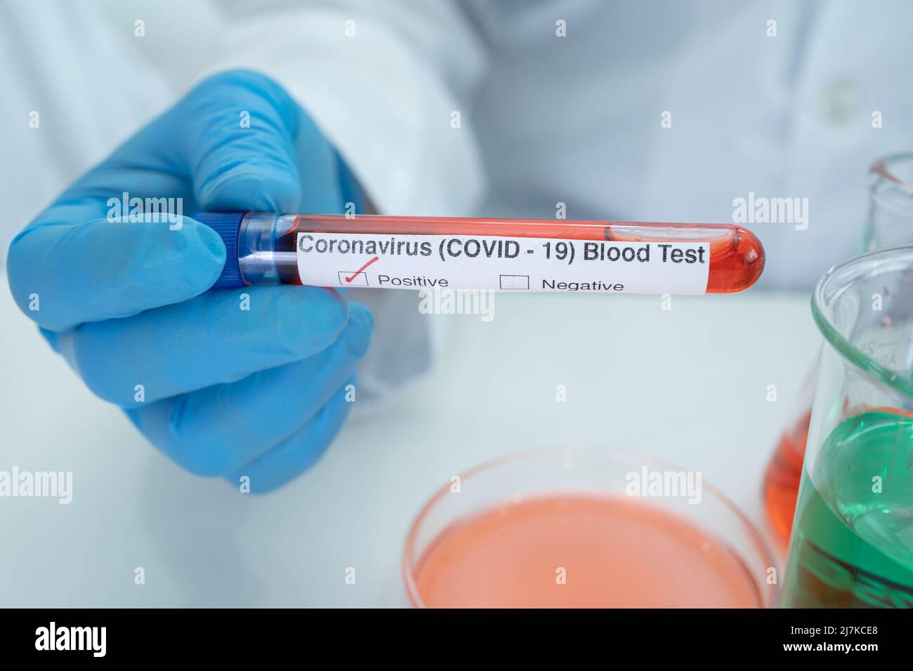 Positive blood infection sample in test tube for covid-19 coronavirus ...