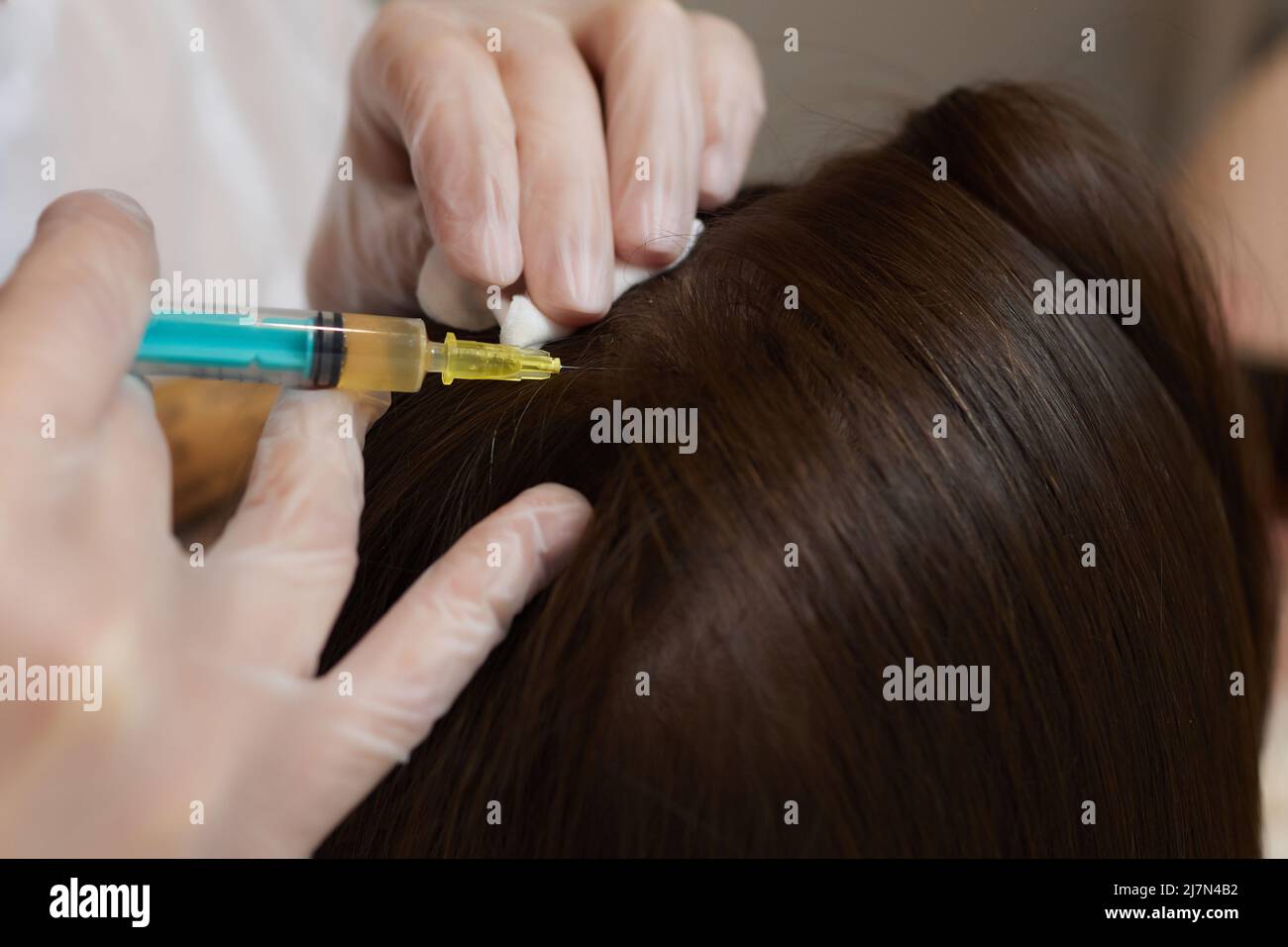 Plasma treatment, plasmolifting or PRP method point the introduction of the patient's own plasma ...