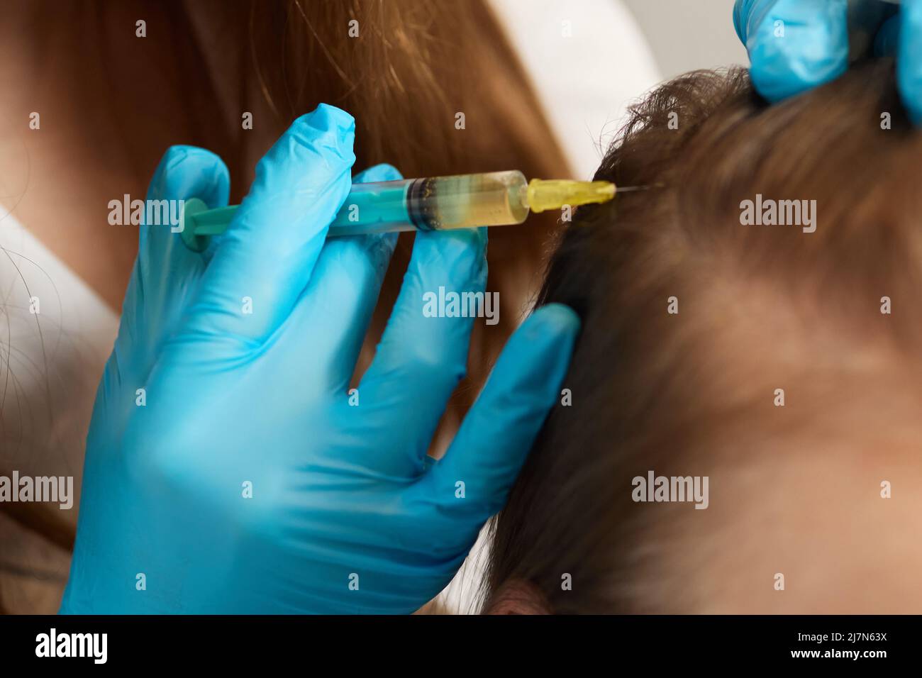 Plasma treatment, plasmolifting or PRP method point the introduction of the patient's own plasma ...