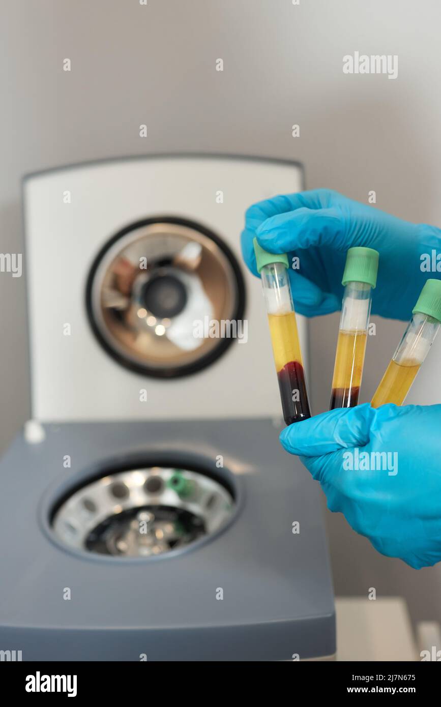 Platelet-Rich plasma preparation. Plasma in syringe. Centrifuge Stock ...
