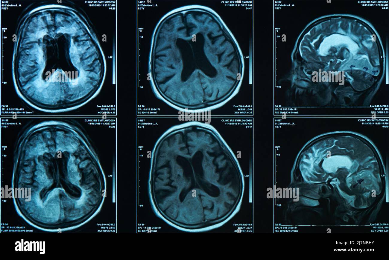 A snapshot of an elderly person's brain scan on magnetic resonance imaging MRI film, for ...