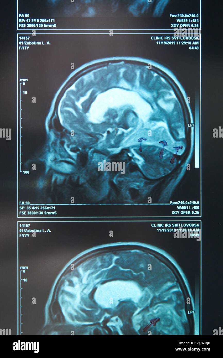 A fragment of an image of an elderly person's brain scan on magnetic ...