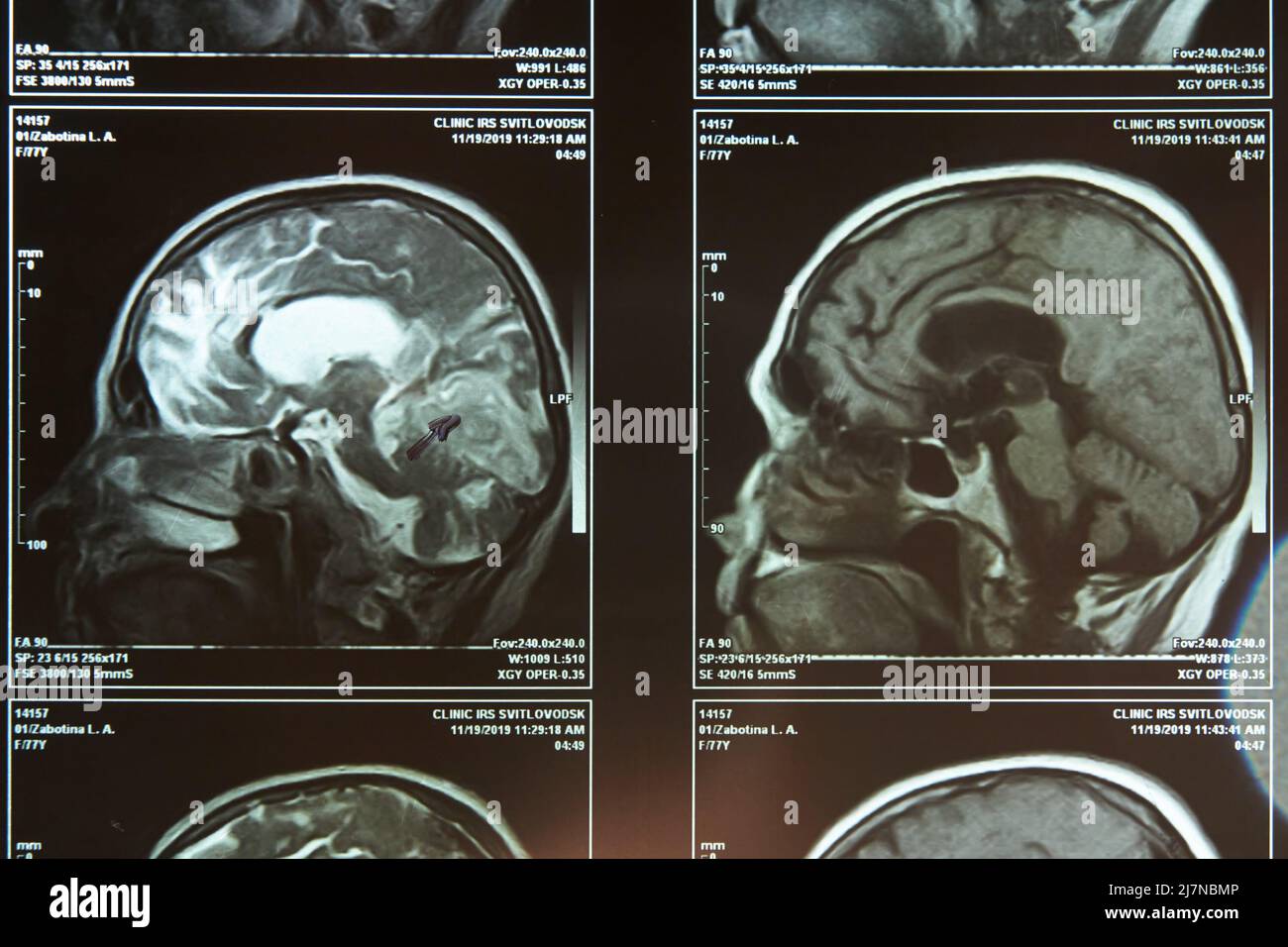 A fragment of an image of an elderly person's brain scan on magnetic ...