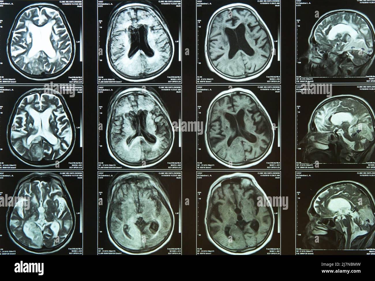 A snapshot of an elderly person's brain scan on magnetic resonance ...