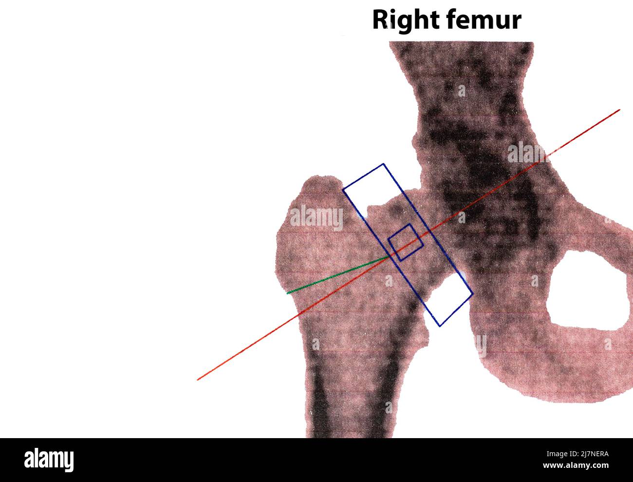 Close-up photo of the right femoral DEXA-osteodensimetry test, which ...