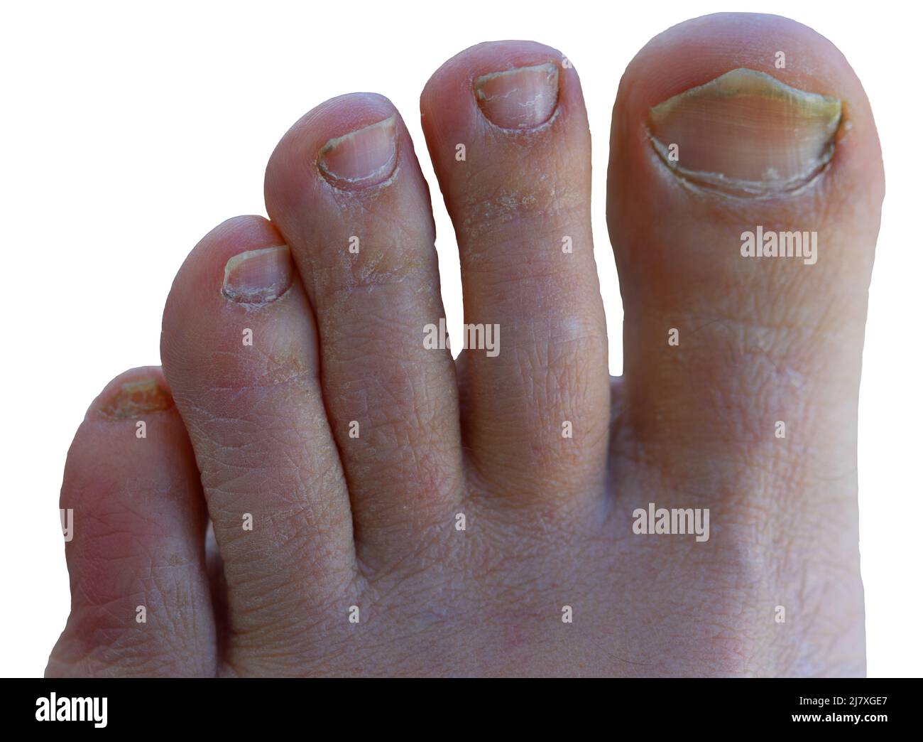 Infected toenails hi-res stock photography and images - Alamy