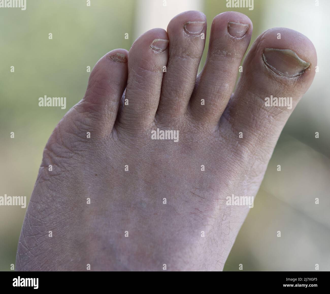 Toes with little toes bent, and toes that are not maintained Stock ...