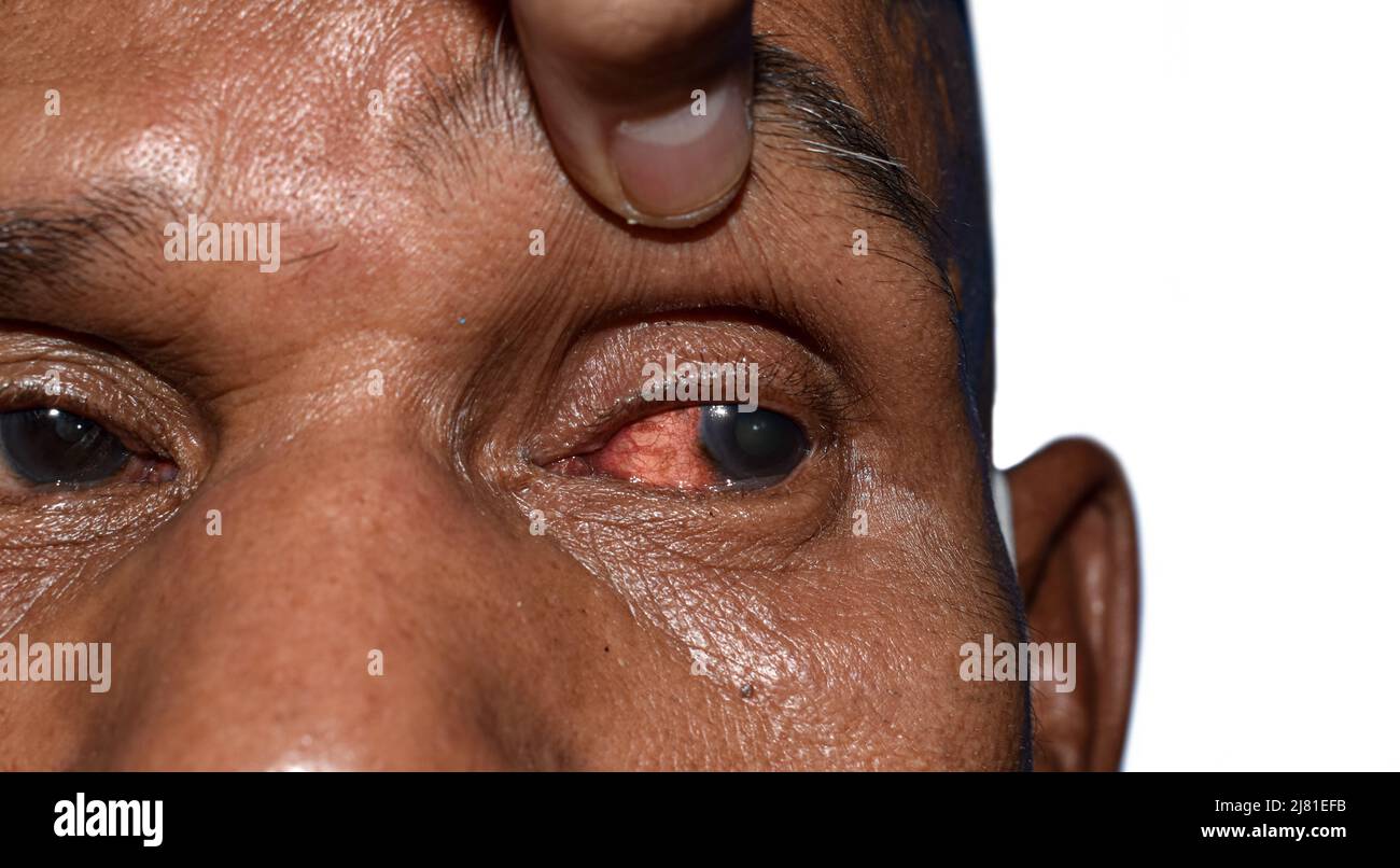 Corneal infection or ulcer called keratitis in Asian old man Stock ...