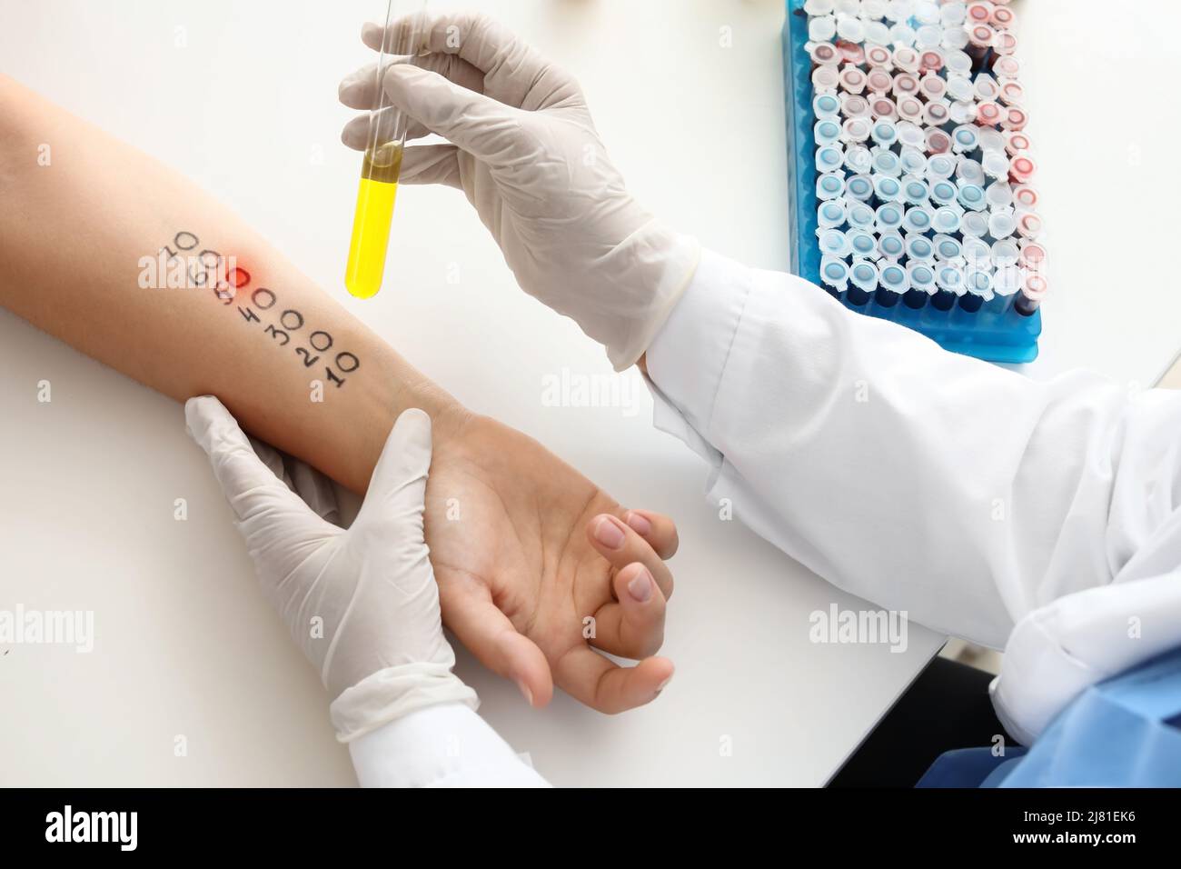 Young woman undergoing procedure of allergen skin tests in clinic Stock ...