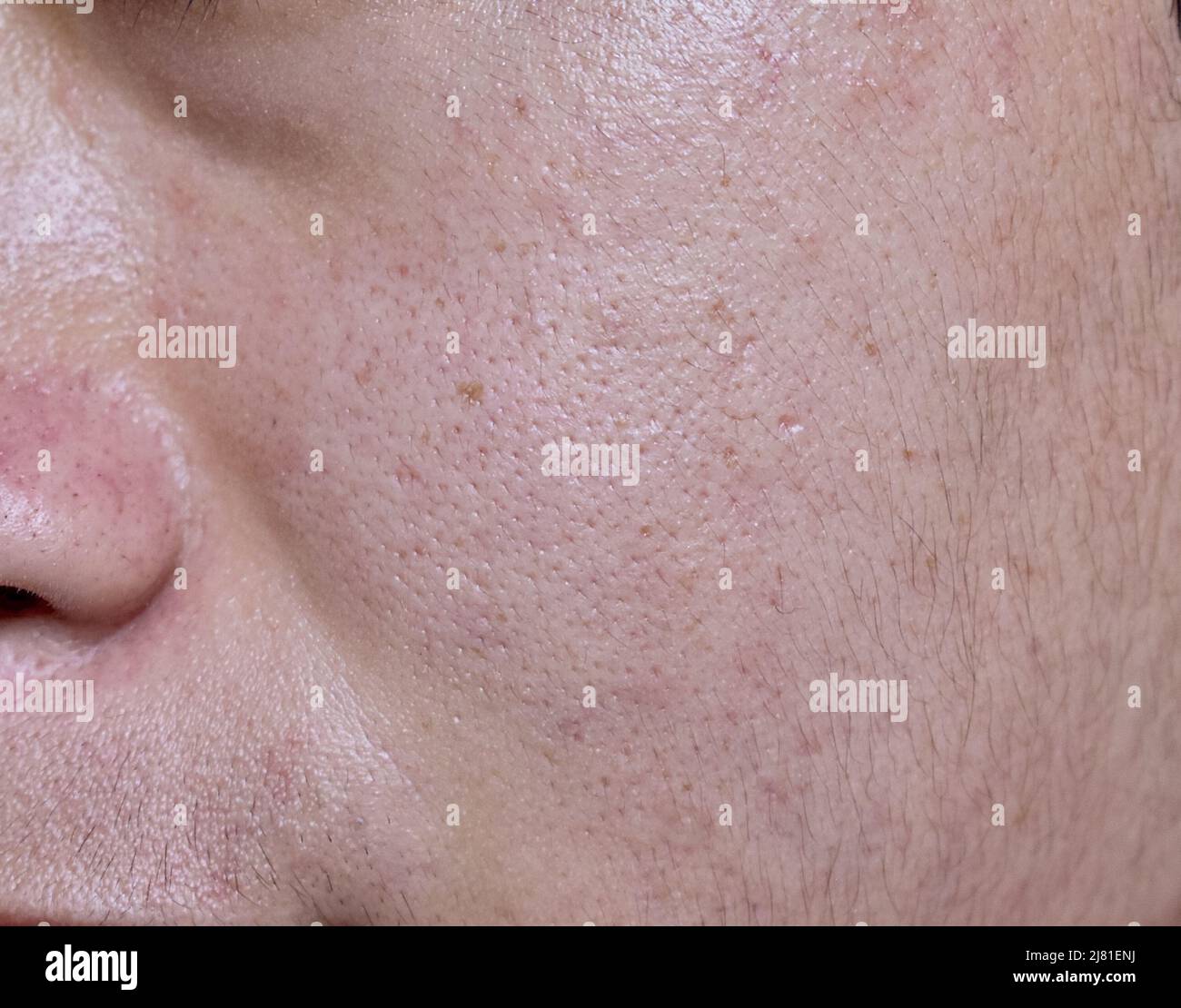 Fair skin with wide pores in face of Southeast Asian, Myanmar or Korean ...