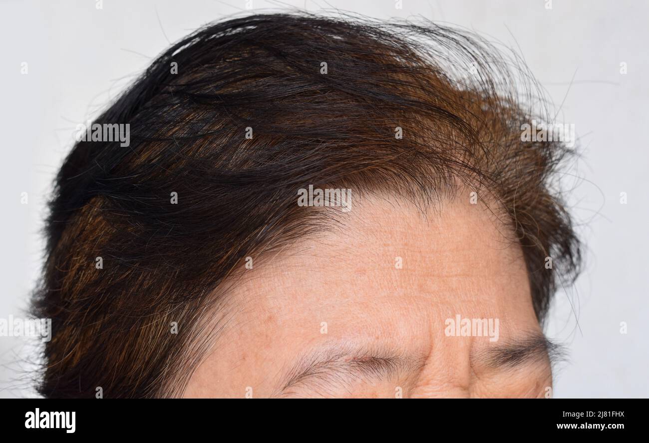 Skin creases or wrinkles at forehead of Southeast Asian, Myanmar or ...