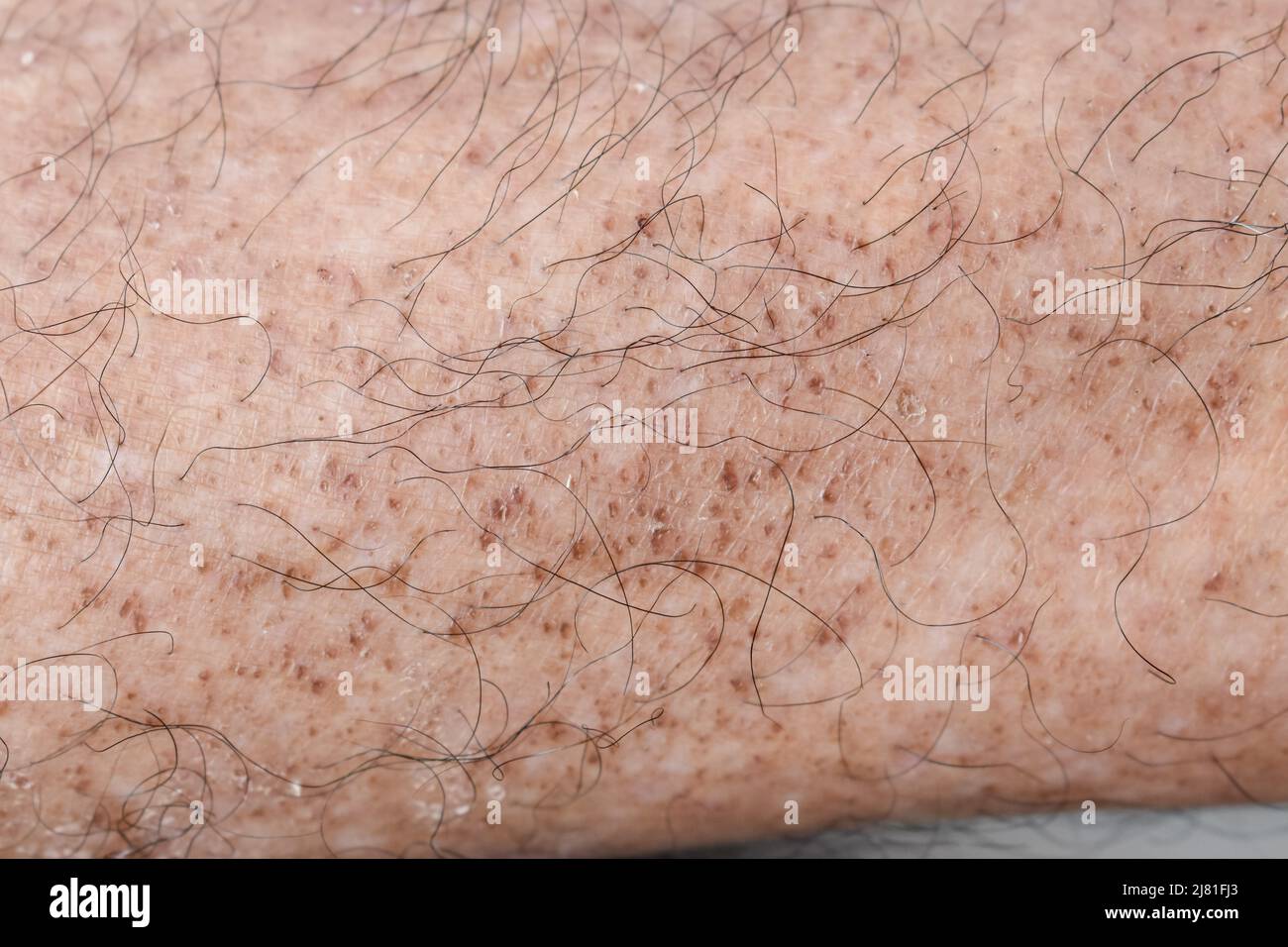 Age spots on leg of Asian elder man. Age spots are brown, gray, or ...