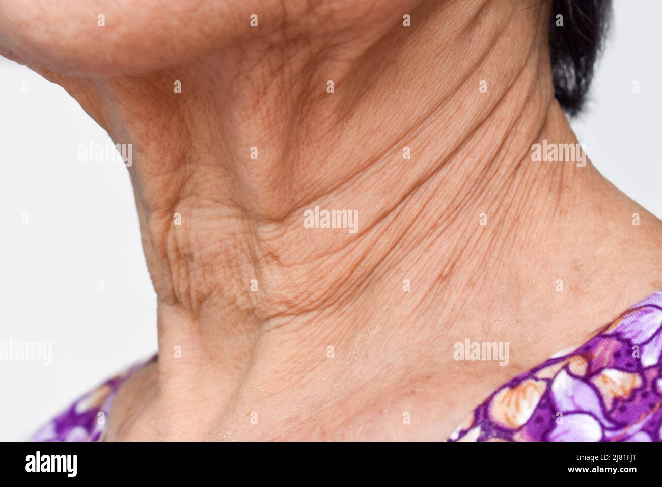 Aging skin folds or skin creases or wrinkles of Southeast Asian ...