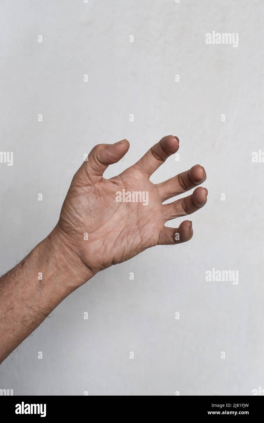 Volkmann’s contracture in left upper limb of Southeast Asian elder man ...